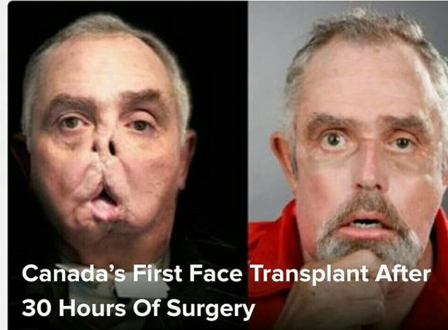 Before and after photos of the first successful face transplant in ...